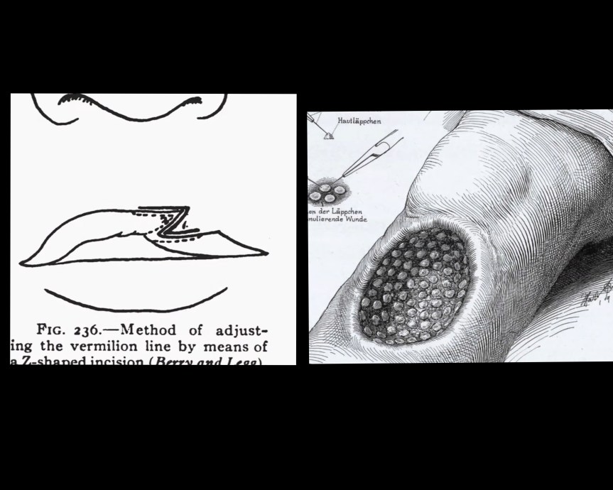 Who was the First Plastic Surgeon? – Track2Training